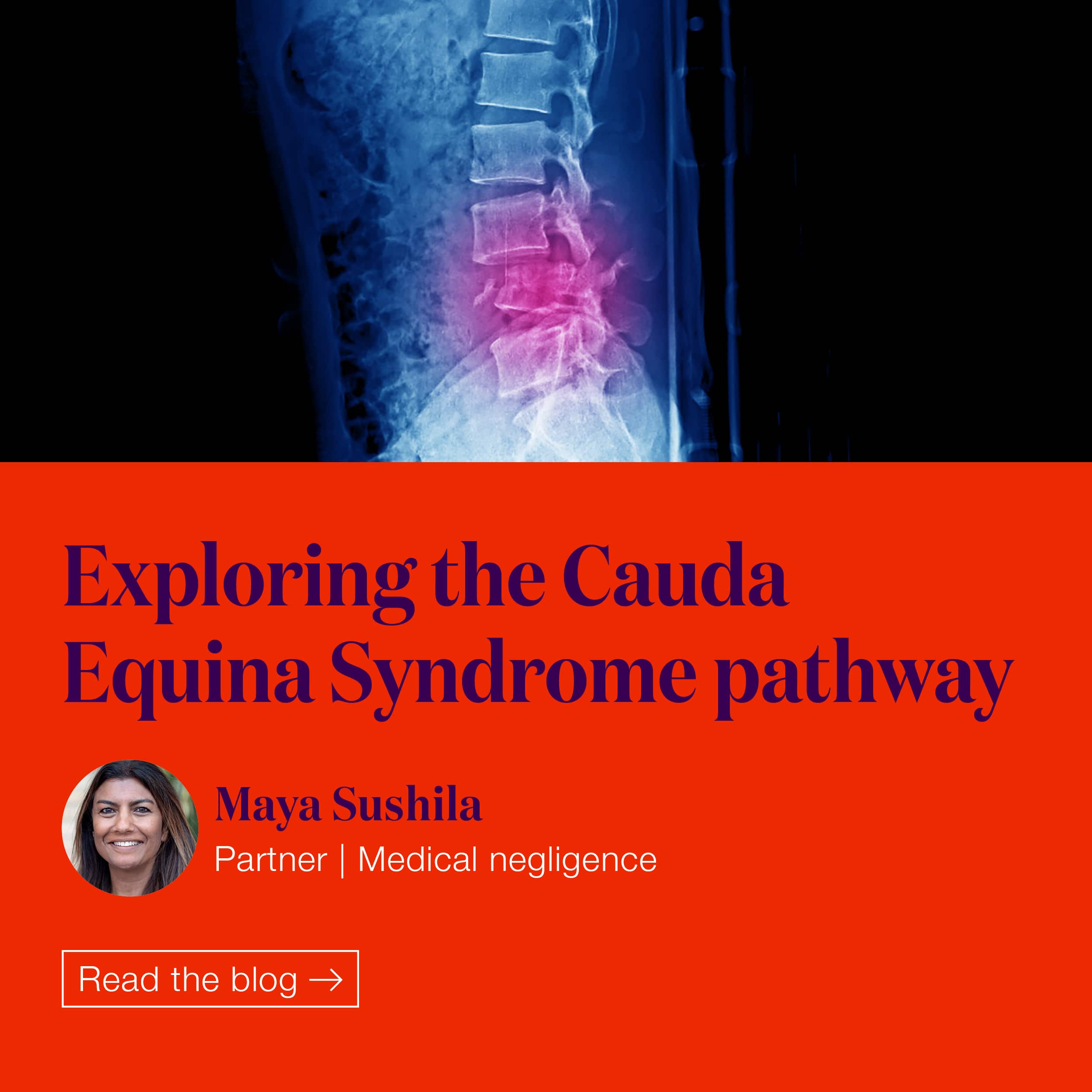 Exploring the Cauda Equina Syndrome pathway - Moore Barlow LLP